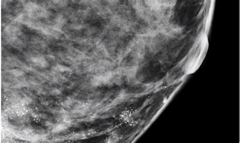 Vitamin D And Calcium Intake May Reduce Risk Of Breast Cancer