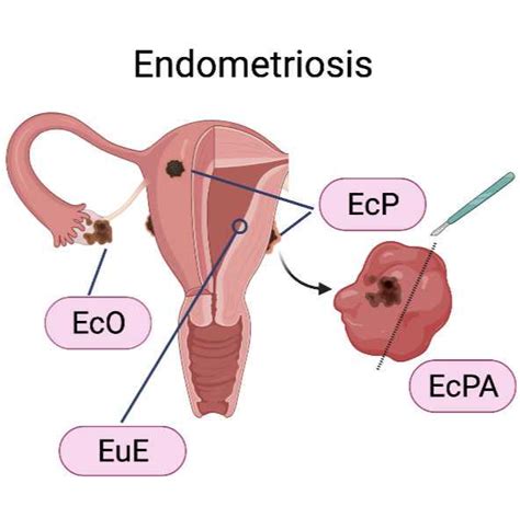 Human Endometrium And Endometriosis Tissue Dissociation For Single Cell Rna Sequencing