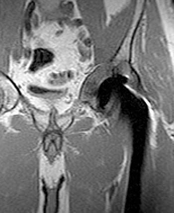 Hip Arthroplasty Radsource