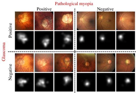 Attention Based Glaucoma Detection A Large Scale Database And Cnn Model Deepai