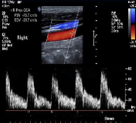 Demonstrates Psv Of The Common Carotid Artery Psv Peak Systolic