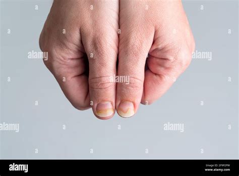 Onychomycosis Or Fungal Nail Infection On Damaged Nails After Gel