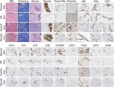 Pyoderma Gangrenosum Symptoms Causes Diagnosis And Treatments Doctor Vin