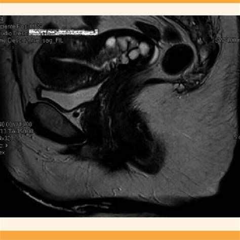 Resonancia Magnética De La Pelvis En T2 Corte Longitudinal Útero Con