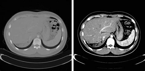 Deep 3d Attention Clstm U Net Based Automated Liver Segmentation And Volumetry For The Liver
