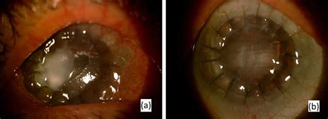 Fungal Keratitis With Hypopyon