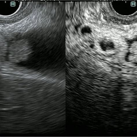 Contrast Enhanced Harmonic Endoscopic Ultrasound Eus For Gallbladder
