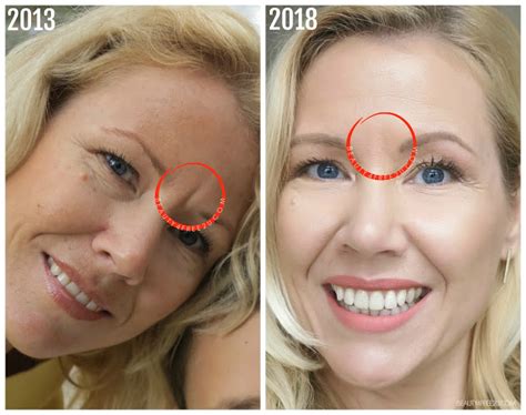 How To Get Rid Of Frown Lines Between Eyes Without Botox Nobotox