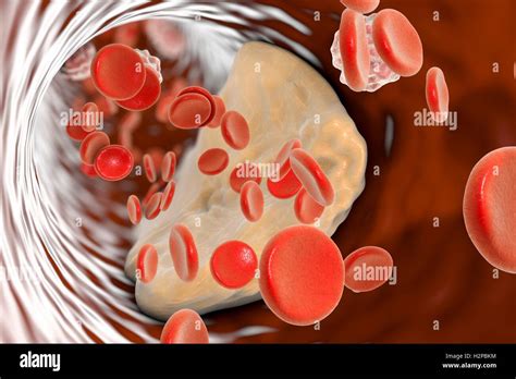 Atheromatous Plaque Inside Blood Vessel Hi Res Stock Photography And Images Alamy