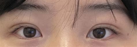 쌍커풀 재수술 자연유착 후기 리얼후기 눈이 예쁘다그래서 아몬드성형외과