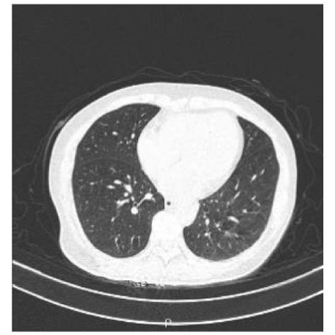 effect drawings of lung parenchyma image segmentation at each stage