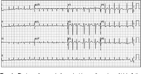 Figure 4 From Development Of Atrial Flutter After Induction Of General Anesthesia And Conversion
