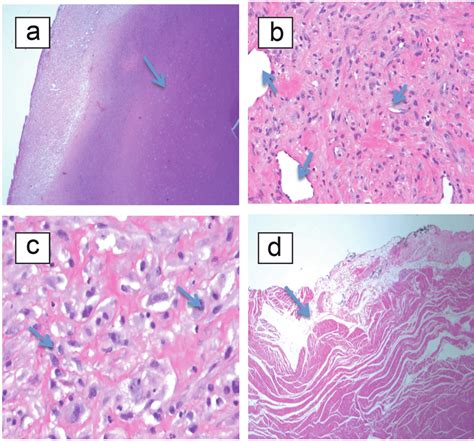 Histopathology Pictures Of Cardiac Intimal Sarcoma Showing Cells Download Scientific Diagram