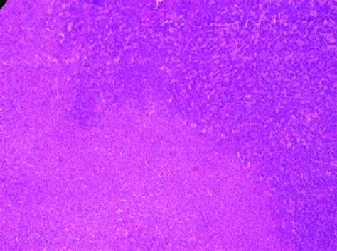 Lymph Node Biopsy Section Showing Patchy Areas Of Necrosis Histiocytes