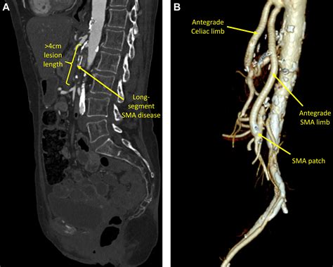 Outcomes Of Open Bypass And Superior Mesenteric Artery Endarterectomy