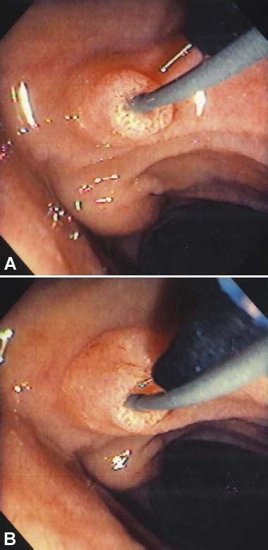 Wire Assisted Minor Papilla Precut Papillotomy Gastrointestinal Endoscopy