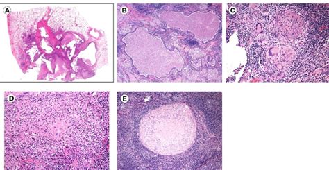 A Lobulated Mass In The Left Lower Lobe Not What It Seems Thorax