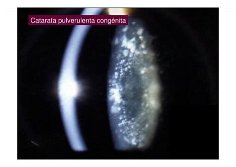 Catarata Perinuclear Bila