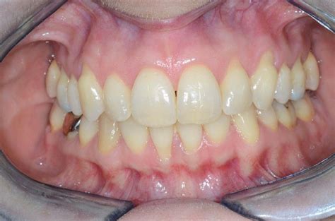 Die Herbst Apparatur Bei Erwachsenen Der Angle Klassen Ii1 Und Ii2