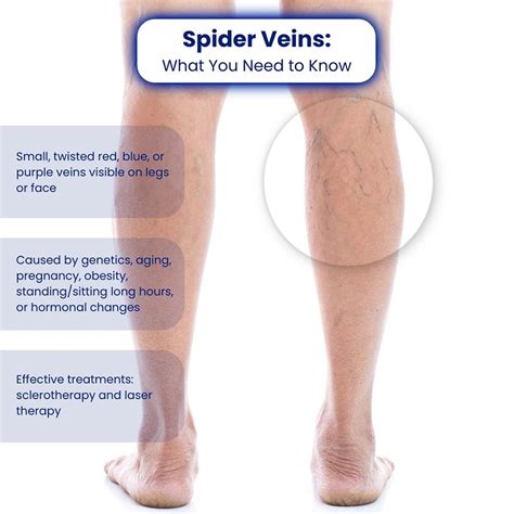 Spider Vein Treatment Specialist In Brooklyn