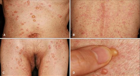 Papules Vs Vesicles