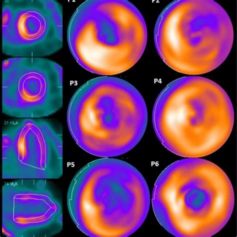 Pdf Tc Hdp Quantitative Spectct In Transthyretin Cardiac Amyloid And