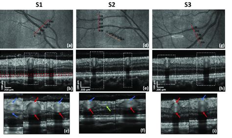 Overview Of B Scans And Their Locations For The Three Study Subjects Download Scientific