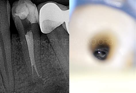 Deep Split Management Tips And Tricks Style Italiano Endodontics