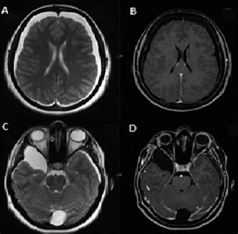 Bilateral Subdural Collection A And Dural Contrast Enhancement B