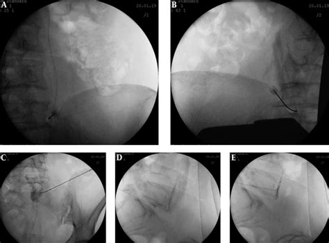 Hypogastric Plexus Neurolysis