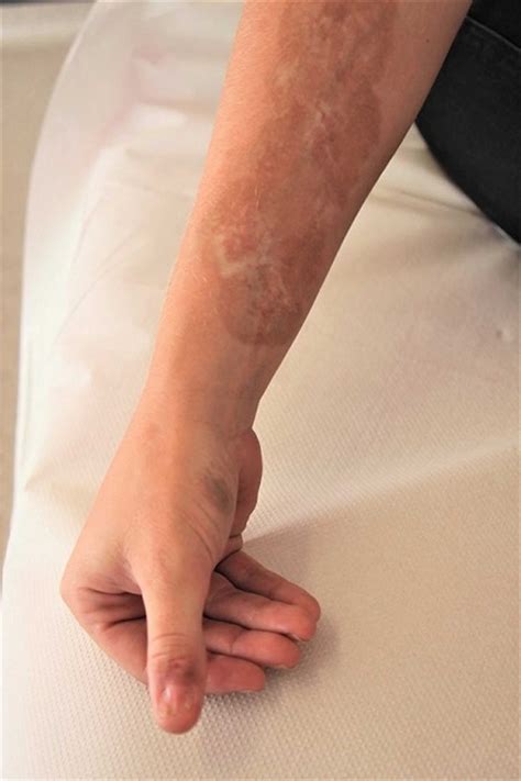 Linear Scleroderma Causes Symptoms Diagnosis Treatment And Prognosis