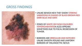 Congenital Nevus Melonocytic Nevus Birth Marks Pptx