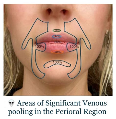 Yousef Nazari On Linkedin 💀 Areas Of Significant Venous Pooling In The