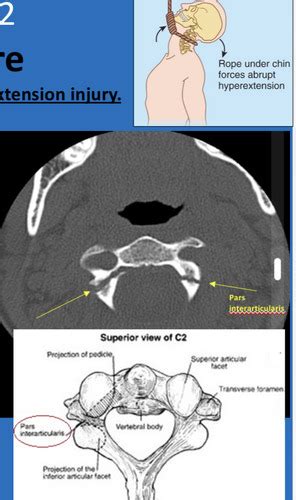 Radiology Of Axial Skeleton Pt 2 Flashcards Quizlet