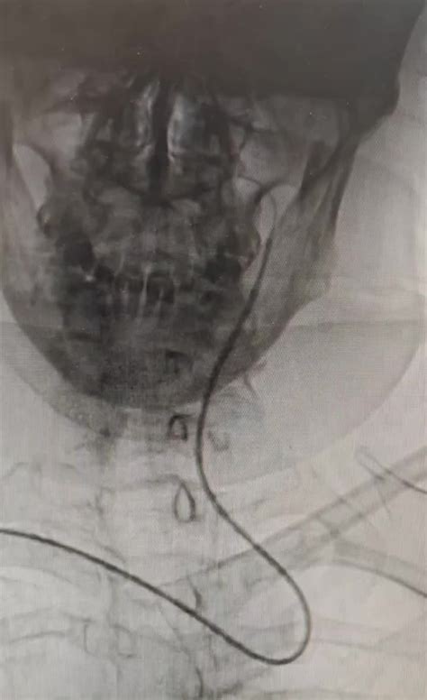 「 术”说卒中」第153期 高效输送 精准定位——apollo颅内动脉支架经桡治疗左侧颈内动脉c3段重度狭窄 脑医汇