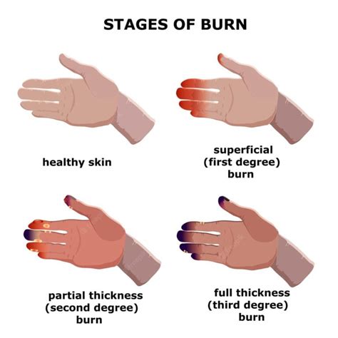 Burn Types Treatment And Nursing Management Medical Surgical Nursing Ent System
