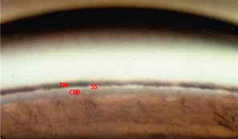 Gonioscopy Glaucoma Associates Of Texas