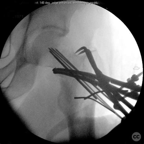 Vertical Displaced Femoral Neck Fracture