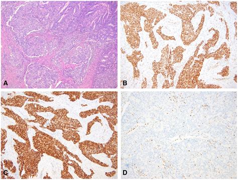 Endometrial Endometrioid Carcinoma A The Patients Endometrial