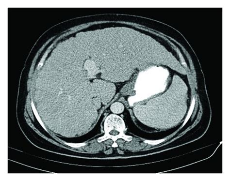 Abdominal Ct Scan Showed Complete Absorption Of Ascites One Month After
