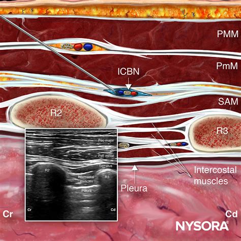 Nysora Nerve Blocks App Nysora