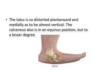 Congenital Vertical Talus Pptx