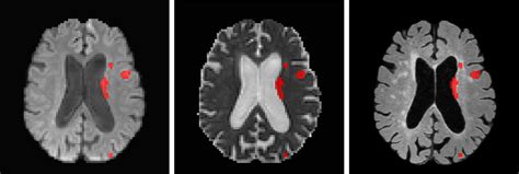 Automated Ischemic Stroke Lesion Segmentation From 3d Mri
