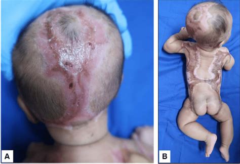 Complete Epithelialization On Day 72 On Scalp A And Trunk B