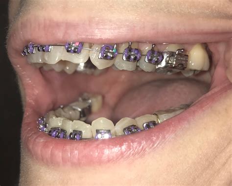 What Are Spacers For Teeth
