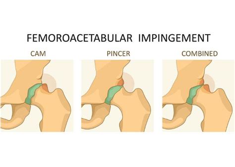 Femoroacetabular Impingement Orthopaedic Wellness Links