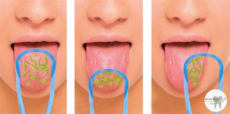 Lengua Fisurada Severa Adultos Dentidown