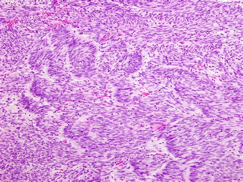 Pathology Outlines GIST