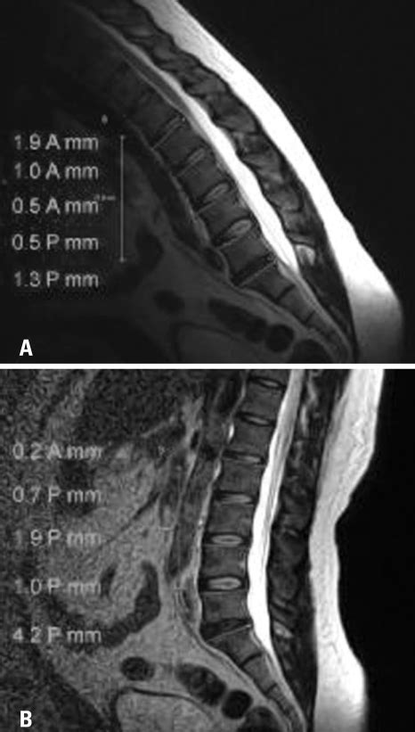 Kmri Measurement Of Segmental Translational Motion At L5 S1 Vertebral