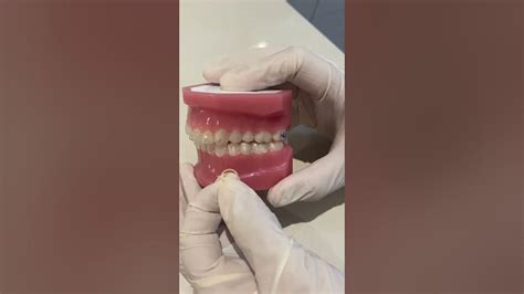 Class Ii Elastics With Invisalign Youtube